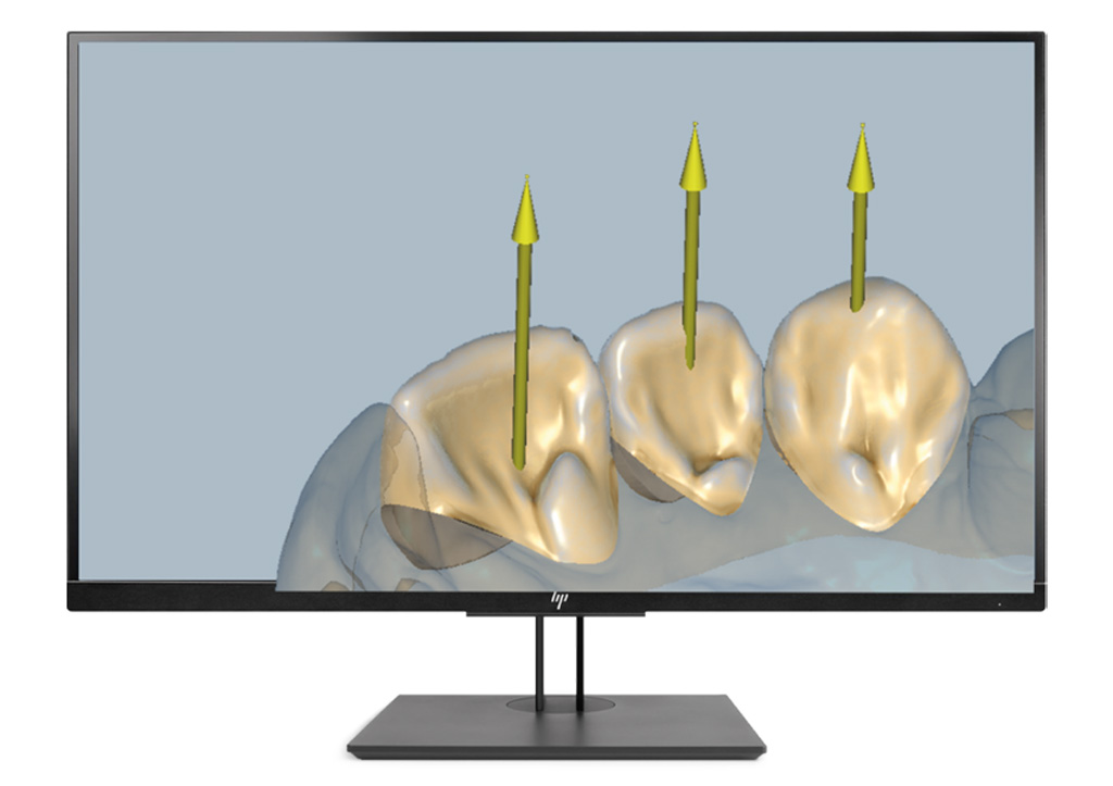Ceramill Microshell – Fabricating esthetic temporary shells - Innovatio ...